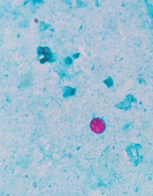 Cyclospora cayetanensis : Classification, Manifestations cliniques et ...