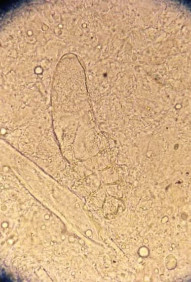 Demodex : Classification, Manifestations cliniques et Identification
