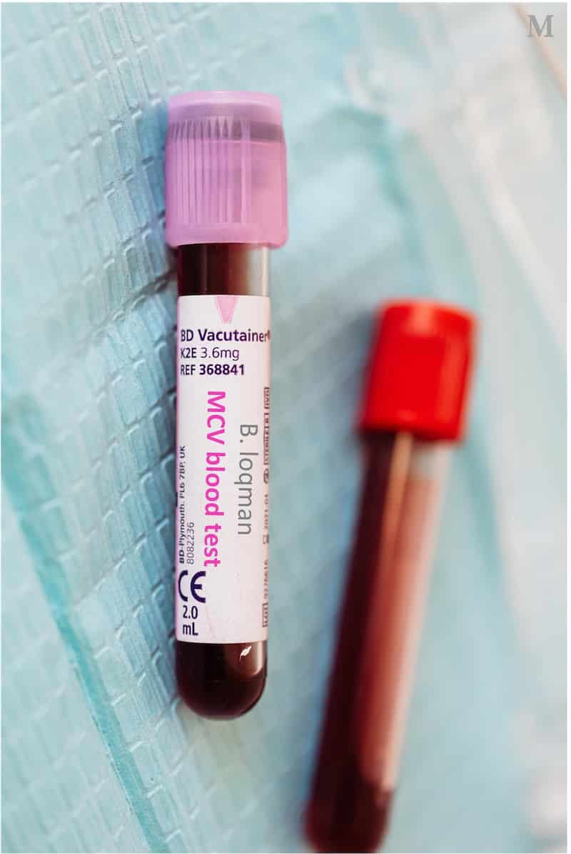 Mcv Blood Test Units at Sarah Lee blog